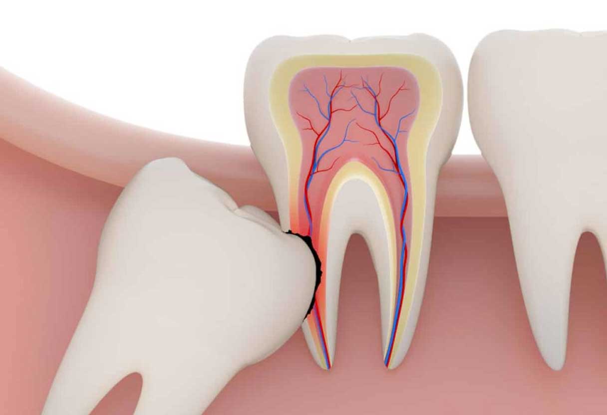 Siso inflamado: causas, sintomas e tratamento - DentalBianco